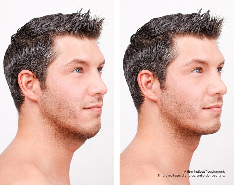 Double menton - Saint Sauveur