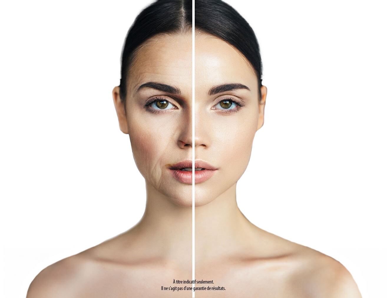 Lifting non chirurgical - Saint Sauveur